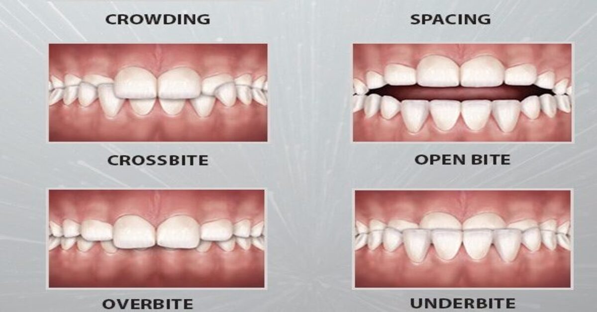 What Are Some Common Orthodontic Problems?